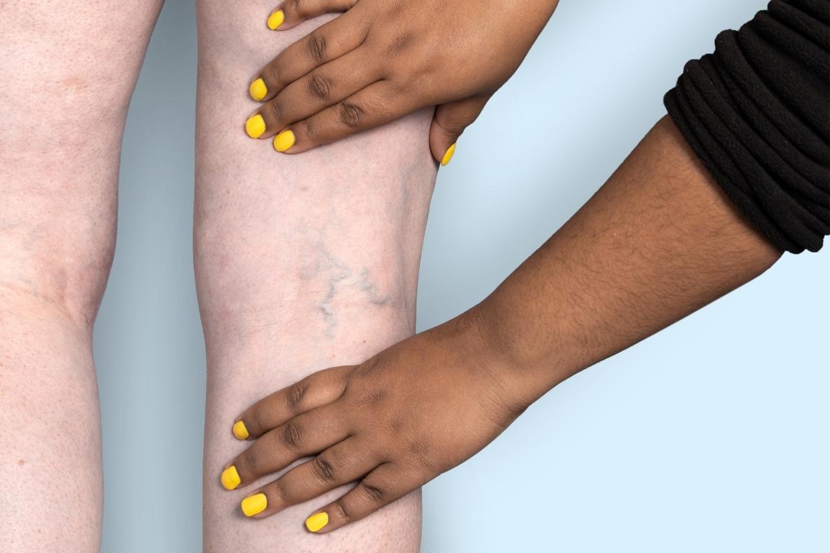 What Your Blue, Green, or Purple Veins Are Telling You | Metro Vein Centers