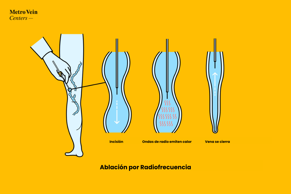¿Qué es la Ablación por Radiofrecuencia? (RFA) | Metro Vein Centers